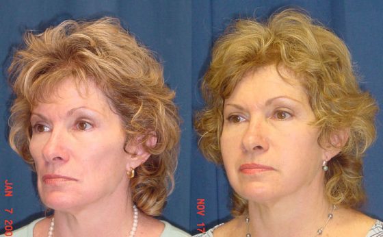 Before & After Fat injections add volume to dermis | Ricardo L ...