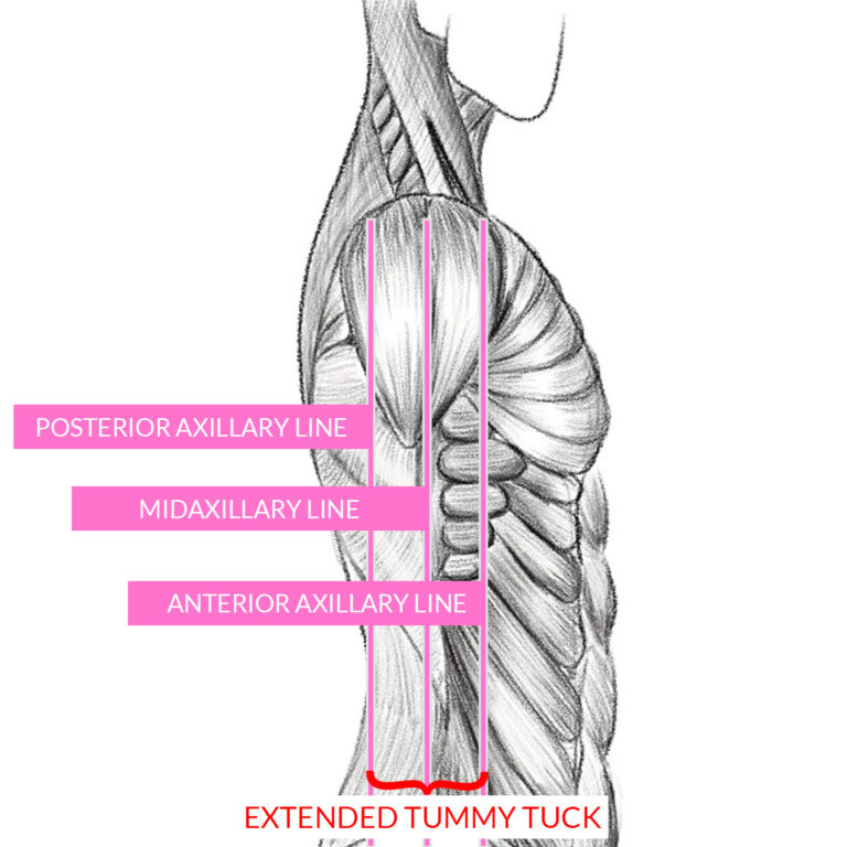 What is an Extended Tummy Tuck? | Ricardo L. Rodriguez MD, Baltimore ...