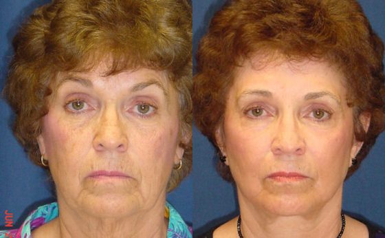 Laser skin resurfacing before & after photos - Dr. Rodriguez ...