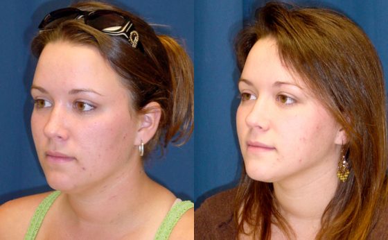 Before & After Liposuction to face | Ricardo L. Rodriguez MD, Baltimore ...