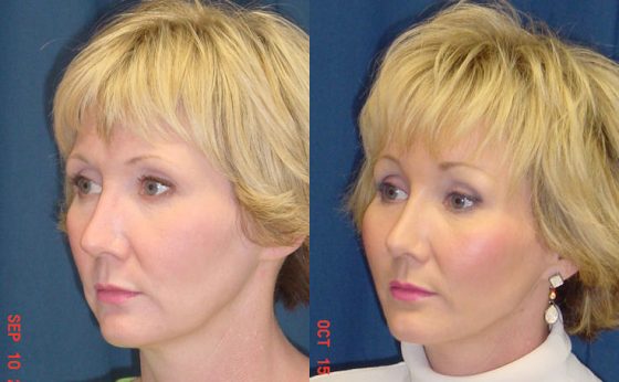 Before & After Mid-facelift and Brow lift on female in her 40s ...